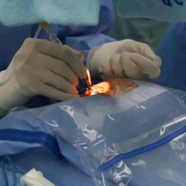 Cataract Surgery in Australia: Costs, Treatments, and What to Expect ...